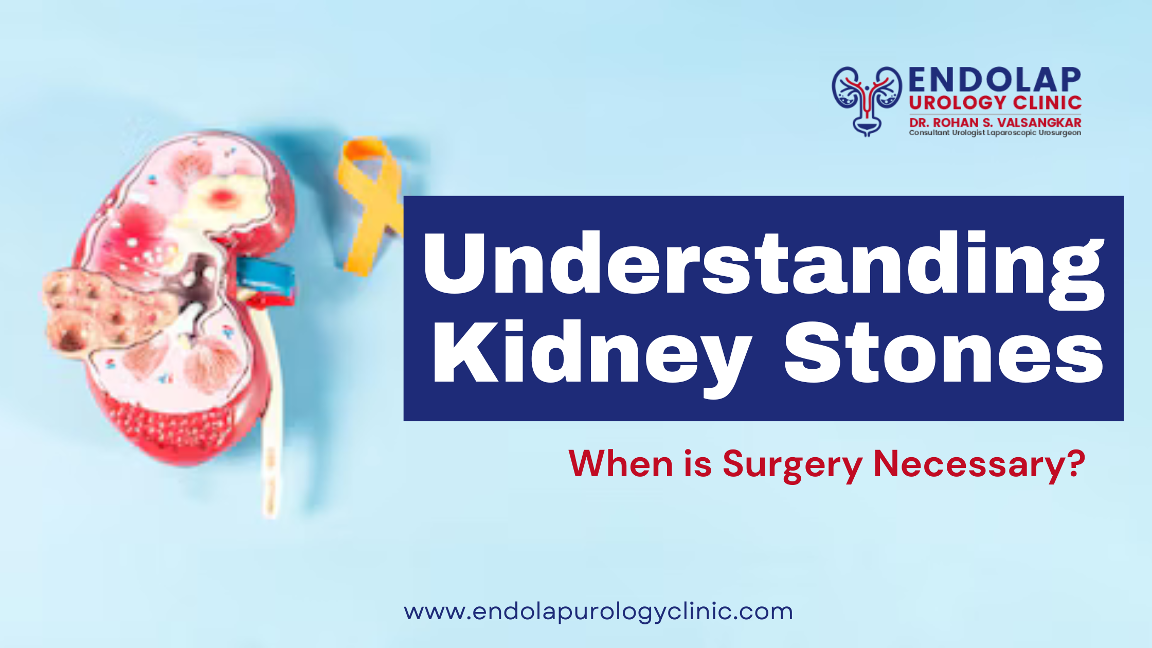 Understanding Kidney Stones: When is Surgery Necessary?
